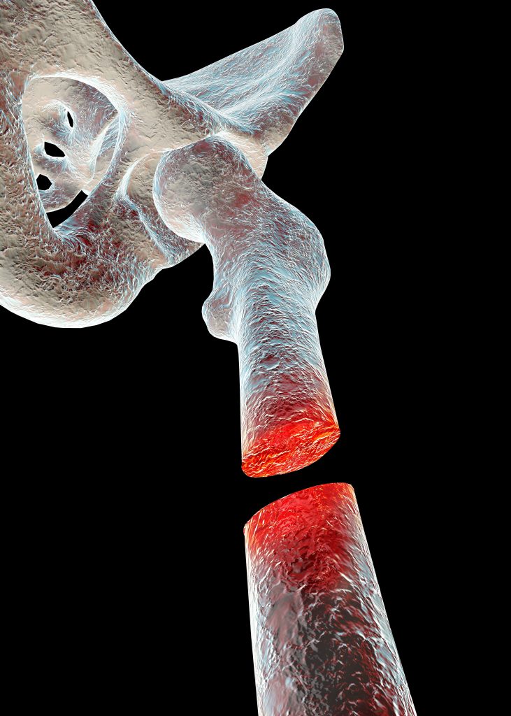 Israeli startup seeks to boost bone renewal and allow targeted drug ...